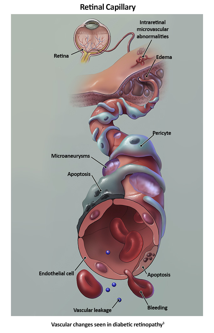 Pathophysiology of NPDR – Nonproliferative Diabetic Retinopathy